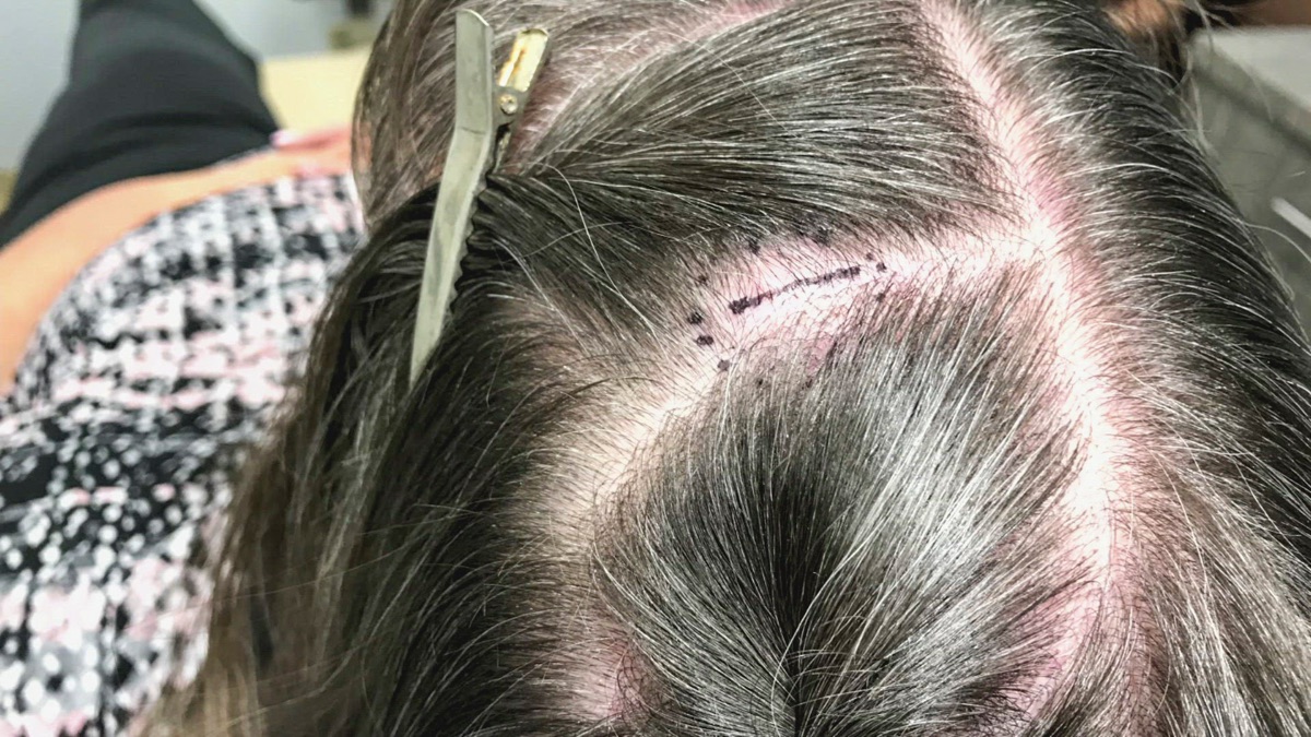 Squirting Pilar Cyst - Dr. Pimple Popper: This Is Zit (Season 8 ...