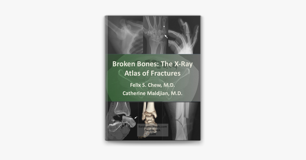 ‎Broken Bones: The X-Ray Atlas of Fractures by Felix Chew & Catherine ...