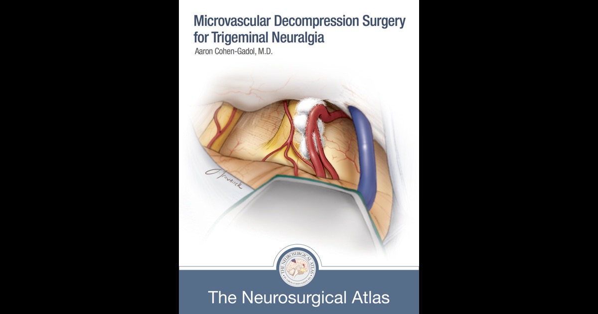 Microvascular Decompression Surgery for Trigeminal Neuralgia by Aaron ...