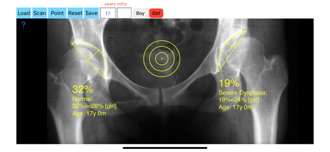 ‎App Store에서 제공하는 AcetabularDepthRatioApp