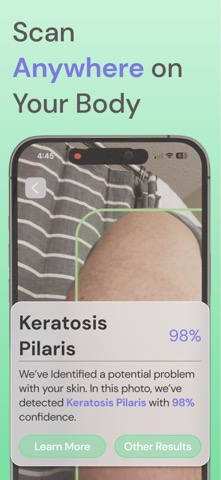 「Rash ID: AI Skin Scanner」 - iPhoneアプリ | APPLION